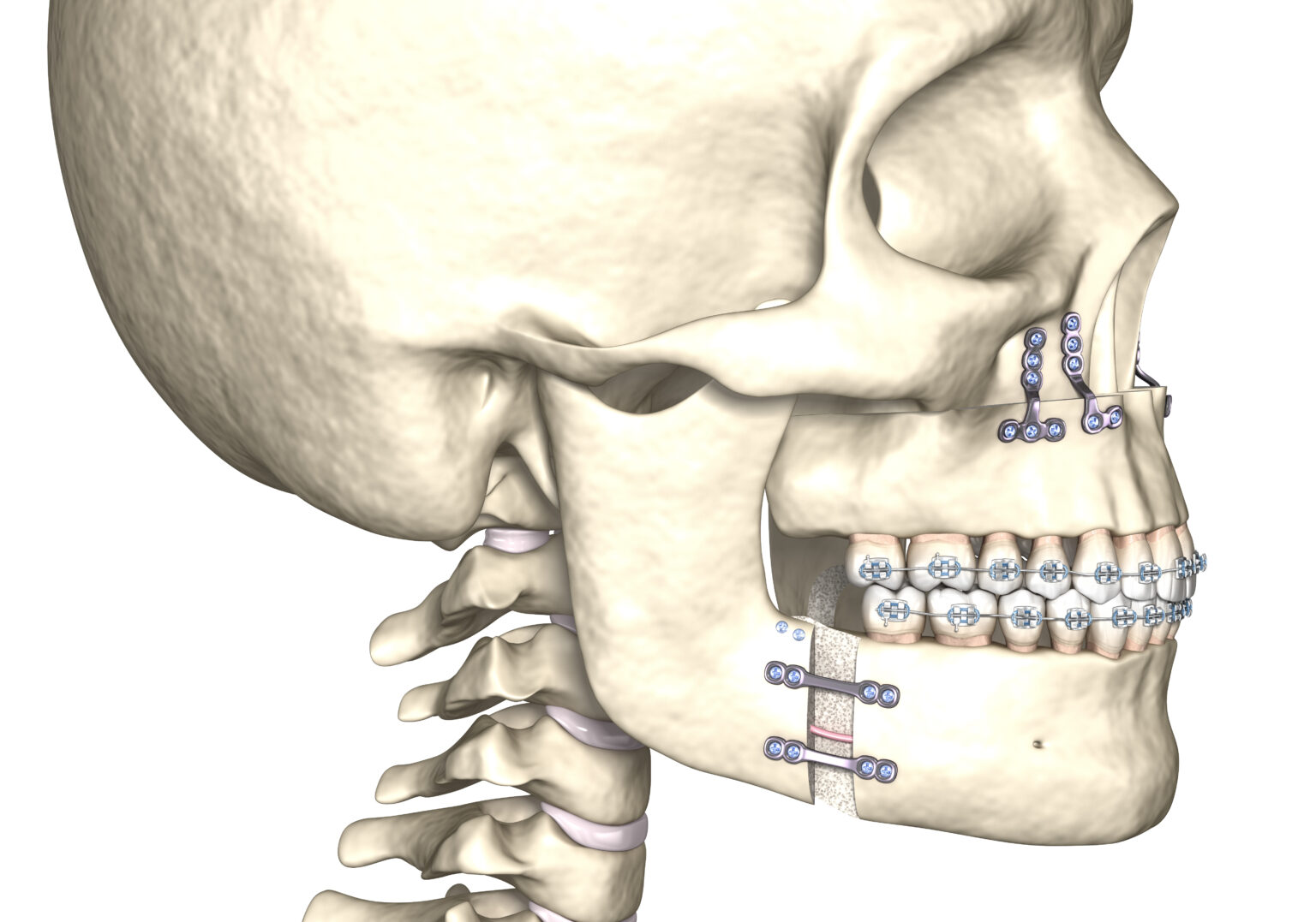 When Your Smile Requires Orthognathic Surgery | Shirley, NY